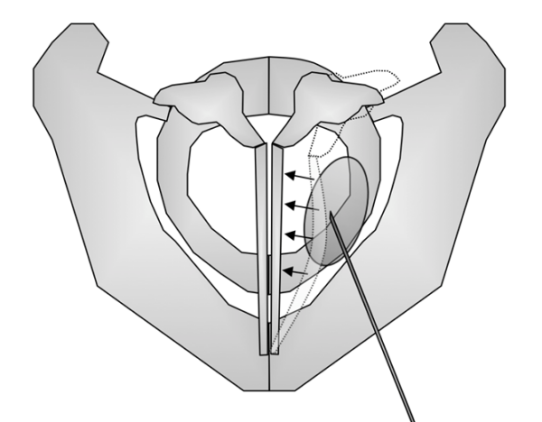 Augmentation | MEDICAL VOICE CENTER