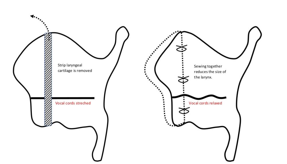 Voice Deepening | MEDICAL VOICE CENTER