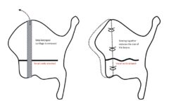 Voice Deepening | MEDICAL VOICE CENTER